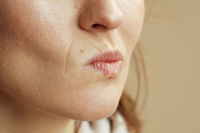 Inflamed Lips – Causes and Treatment Methods | BIOTHERM